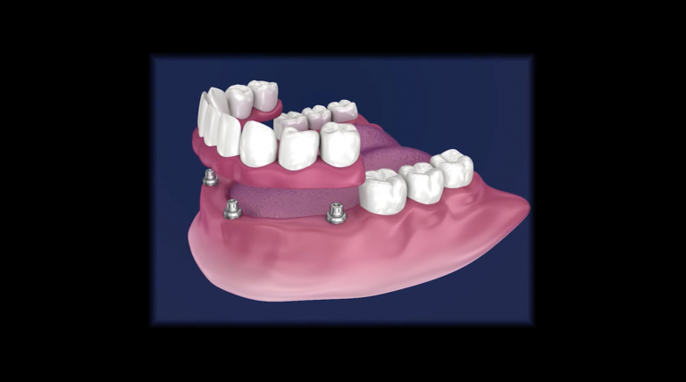 Anchoring Your Dentures – Implant-supported Options